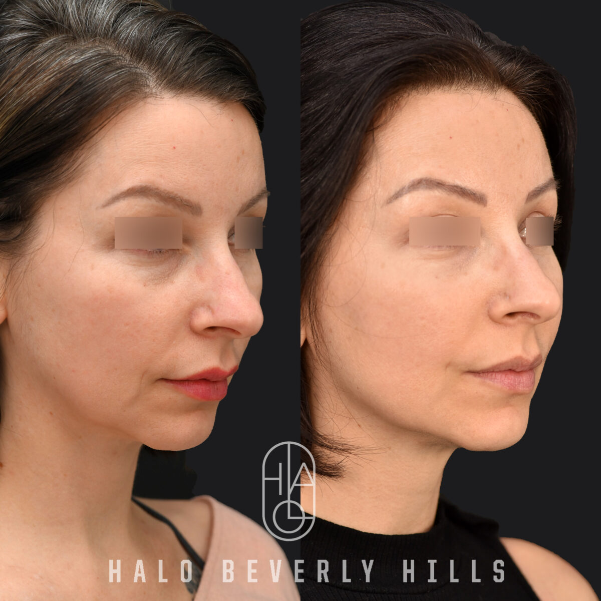 Sculptra Injections - Halo Beverly Hills