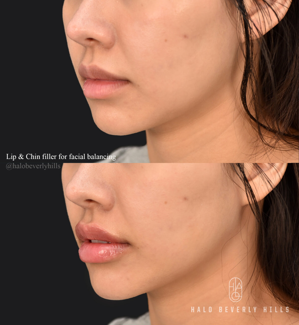Facial Balancing - Halo Beverly Hills