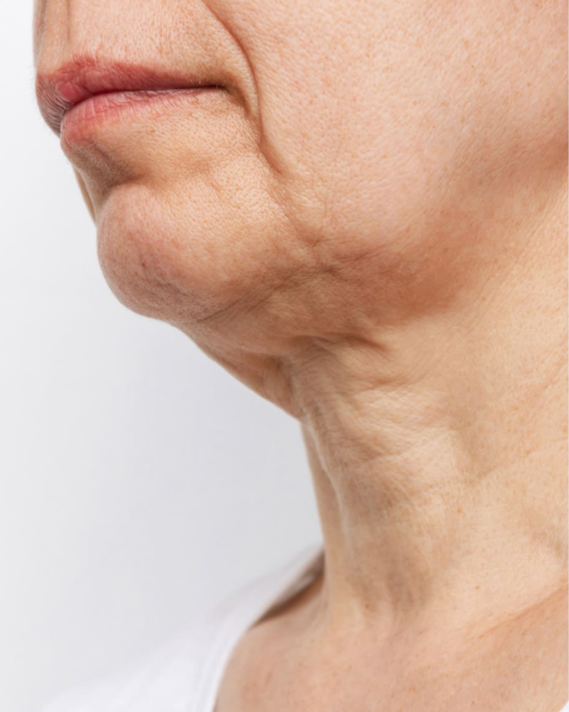 Skin Laxity - Halo Beverly Hills